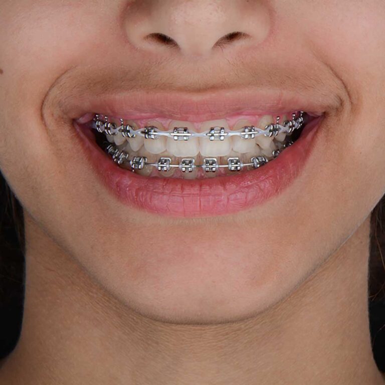 Ceramic Braces - Dental & Facial Aesthetics