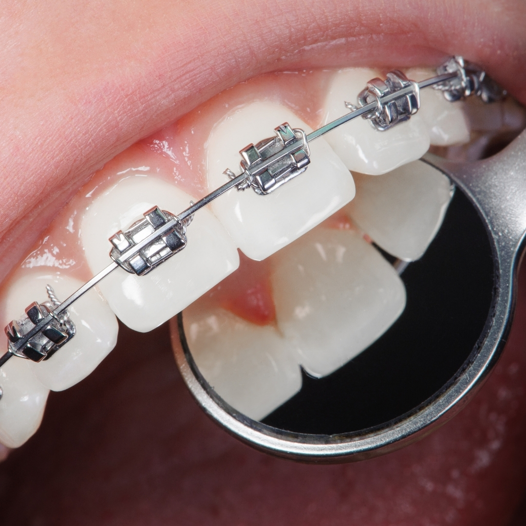 Self-Ligating Braces – Dental & Facial Aesthetics